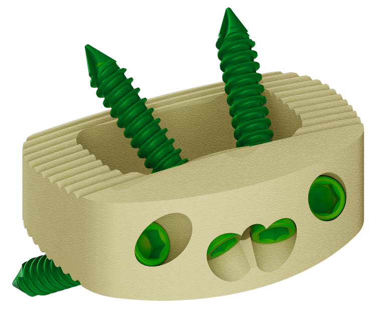 ALIF - American Implant